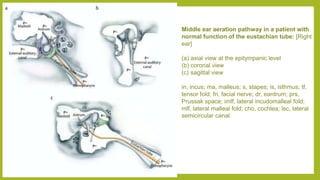 Middle ear ventilatory pathway and Mucosal folds.pptx