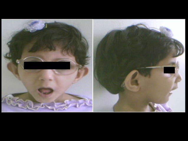 Middle east syndrome, sanjad sakati syndrome