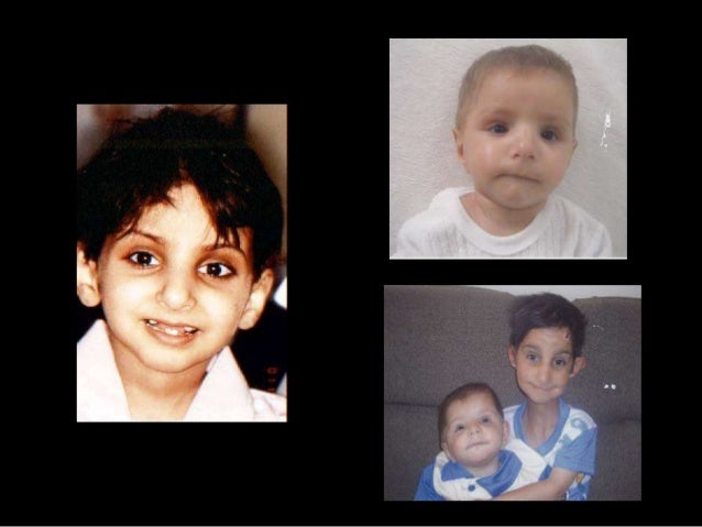 Middle east syndrome, sanjad sakati syndrome