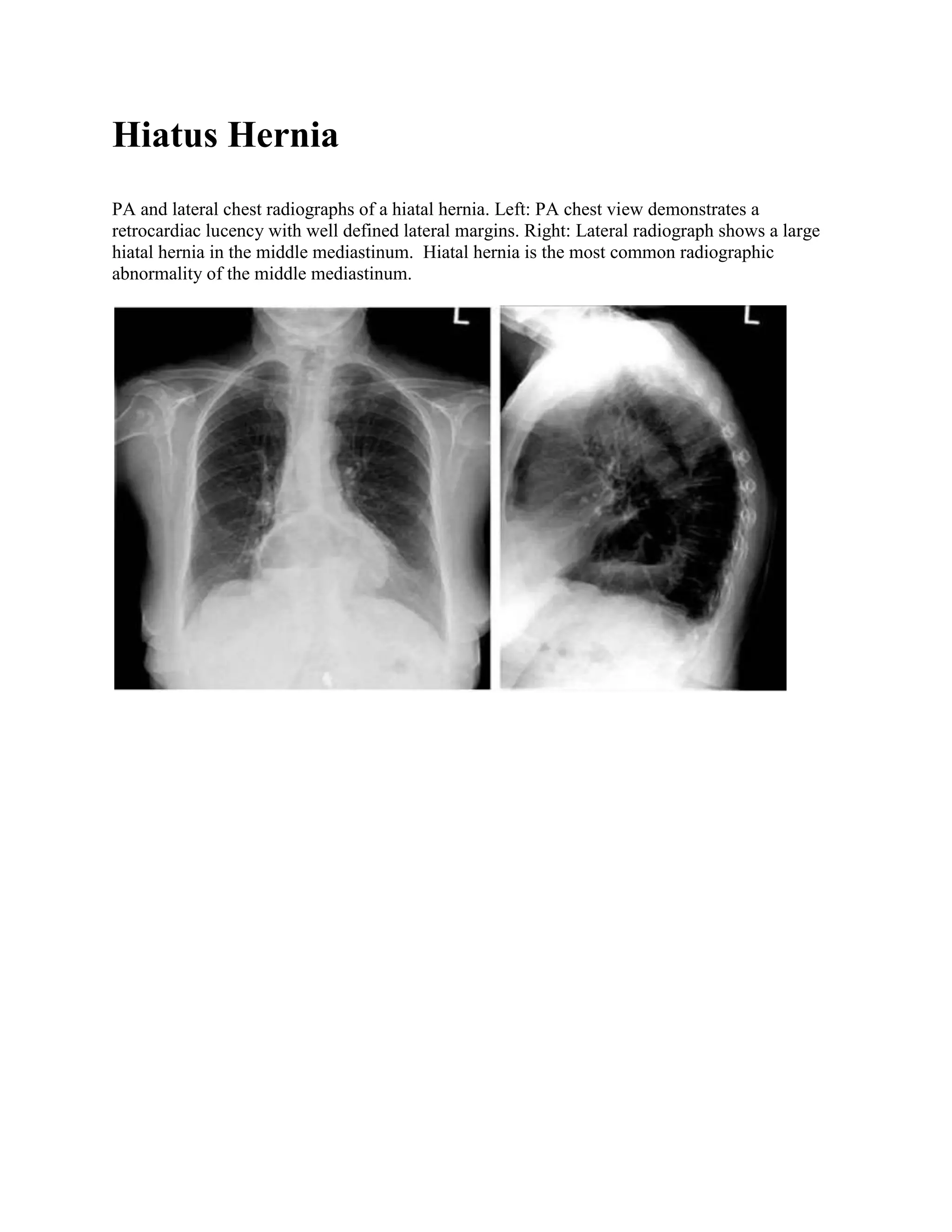 Middle mediastinal mass | DOCX