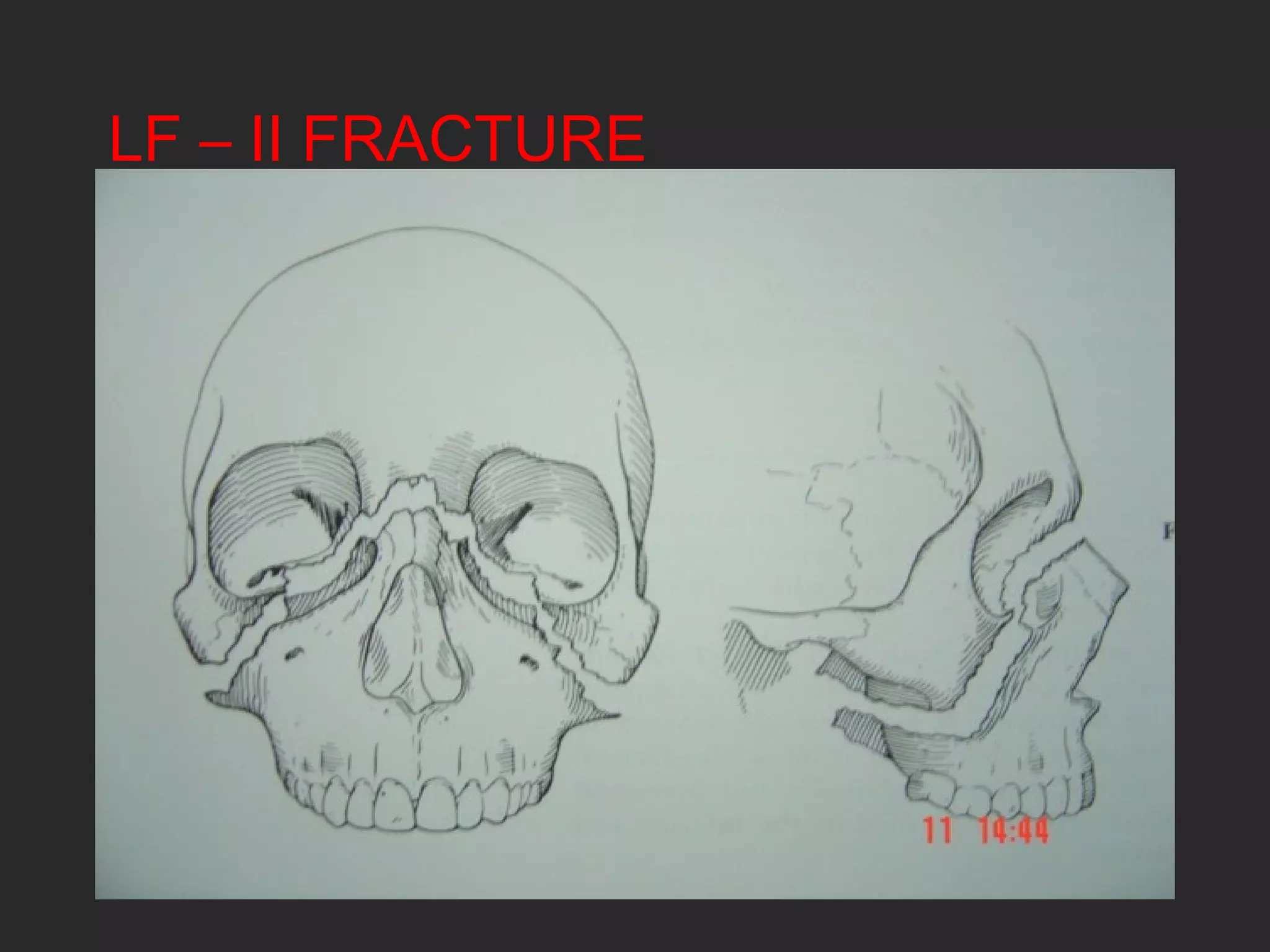 Middle third fracture & management ih | PPT