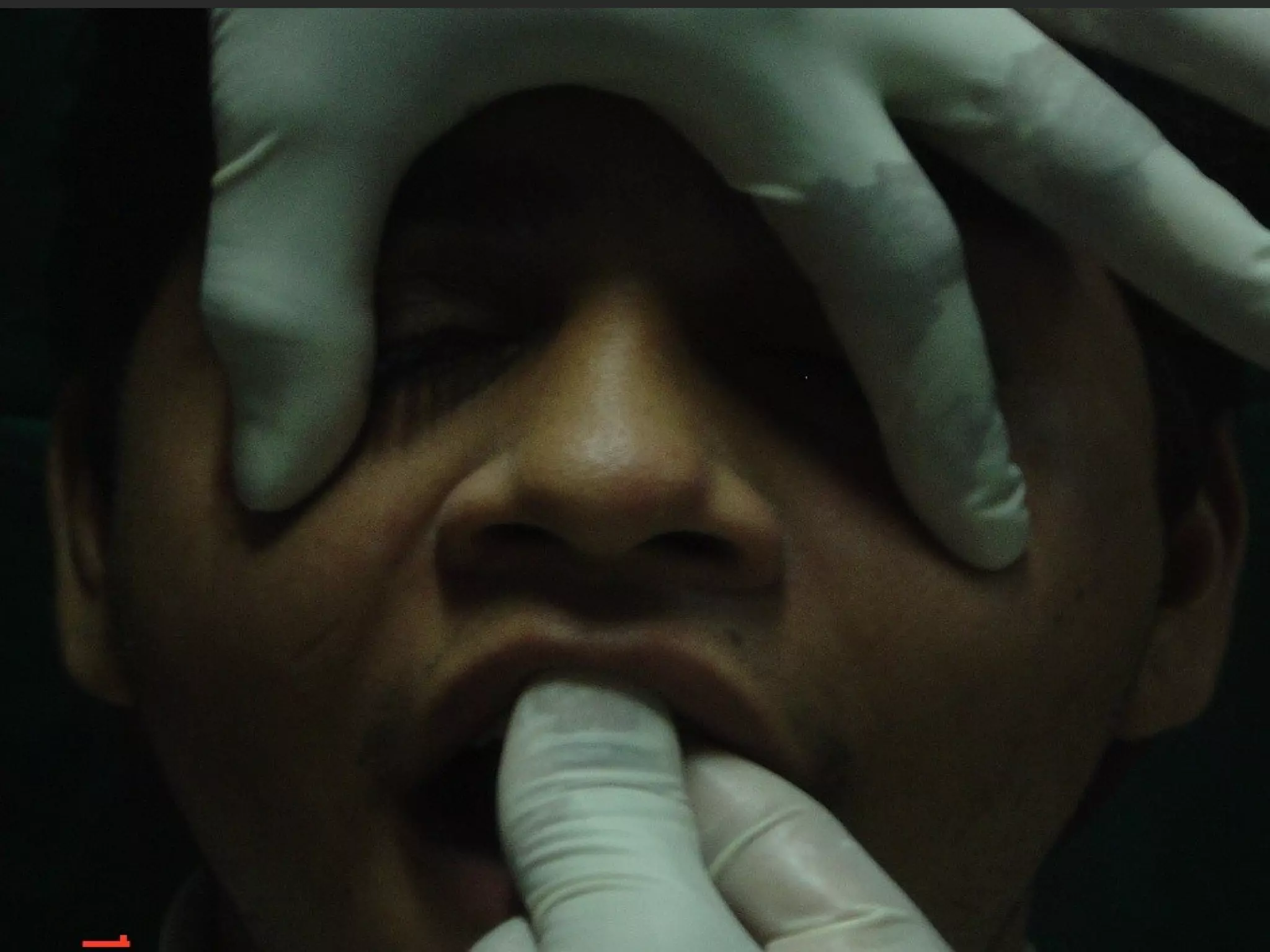 Middle third fracture & management ih | PPT