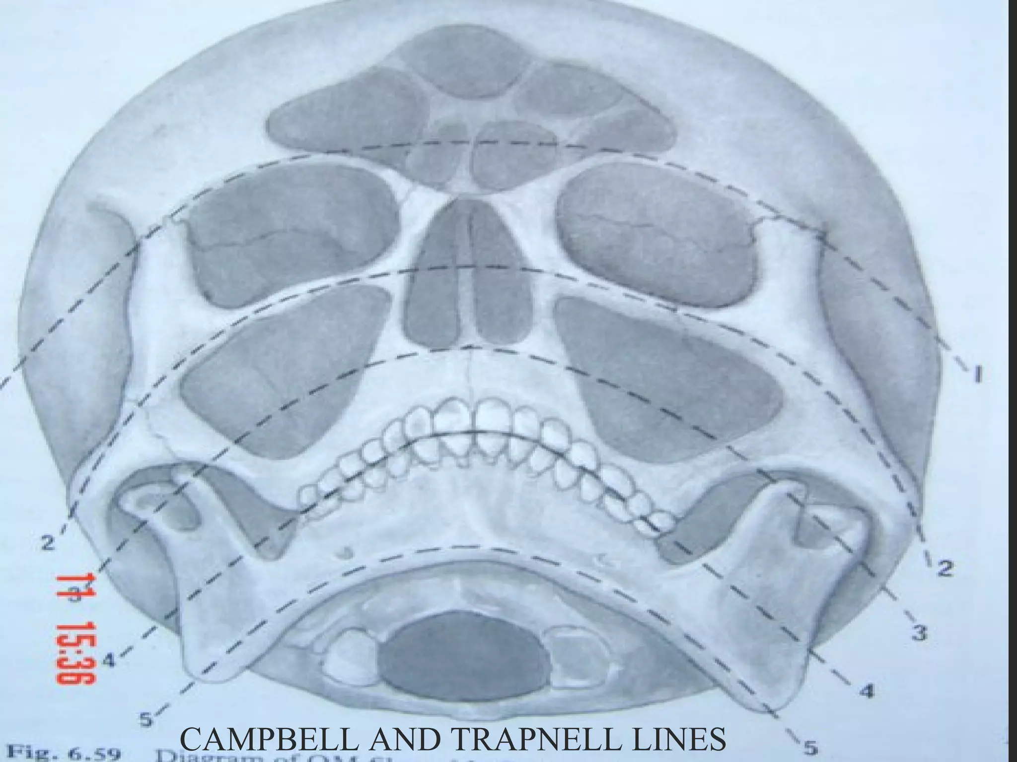 Middle third fracture & management ih | PPT