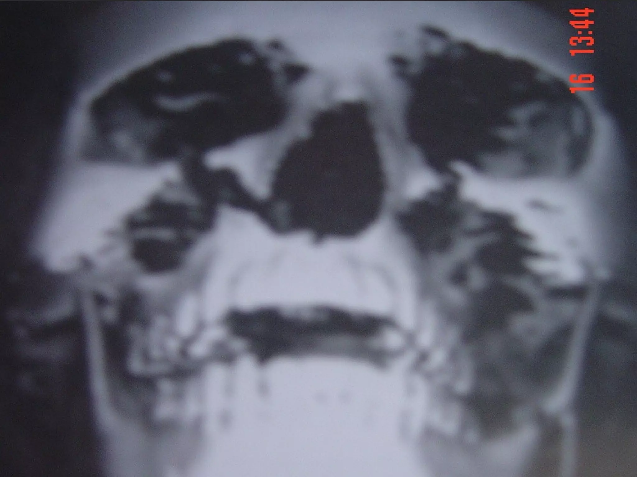 Middle third fracture & management ih | PPT