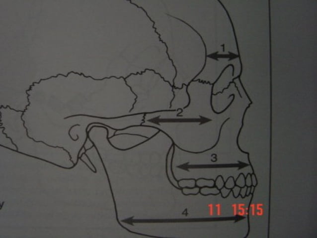 Middle third fracture & management ih | PPT