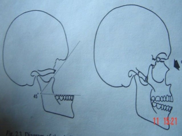 Middle third fracture & management ih | PPT