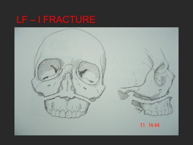 Middle third fracture & management ih | PPT