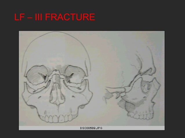 Middle third fracture & management ih | PPT