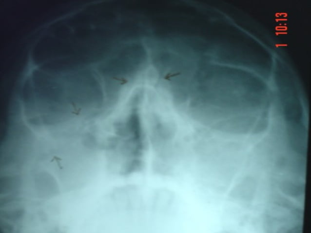 Middle third fracture & management ih | PPT