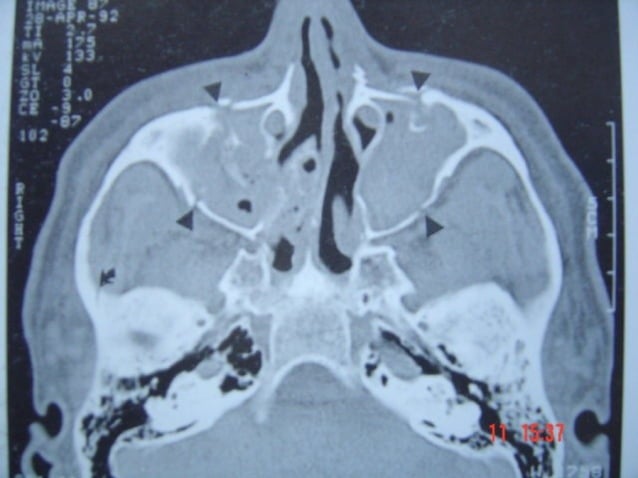 Middle third fracture & management ih | PPT