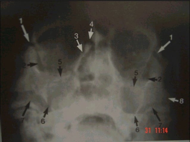 Middle third fracture & management ih | PPT