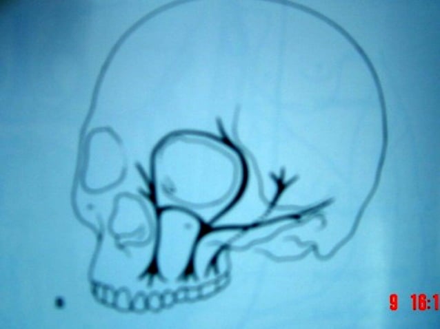 Middle third fracture & management ih | PPT