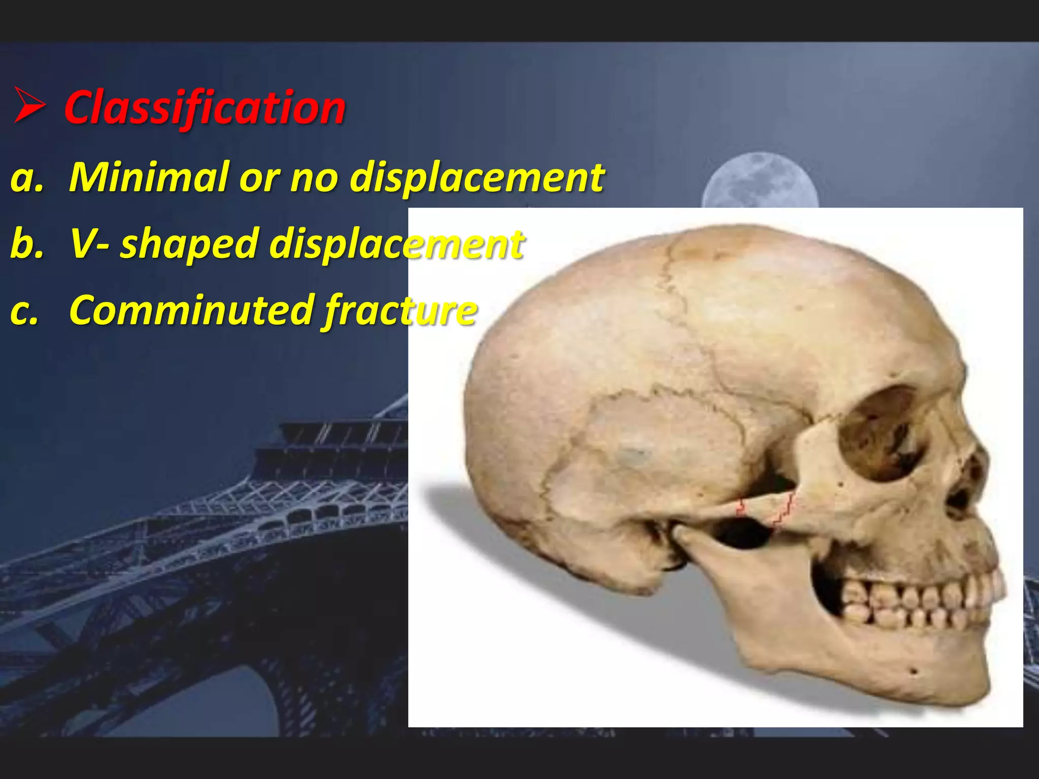 Middle third fractures | PPSX