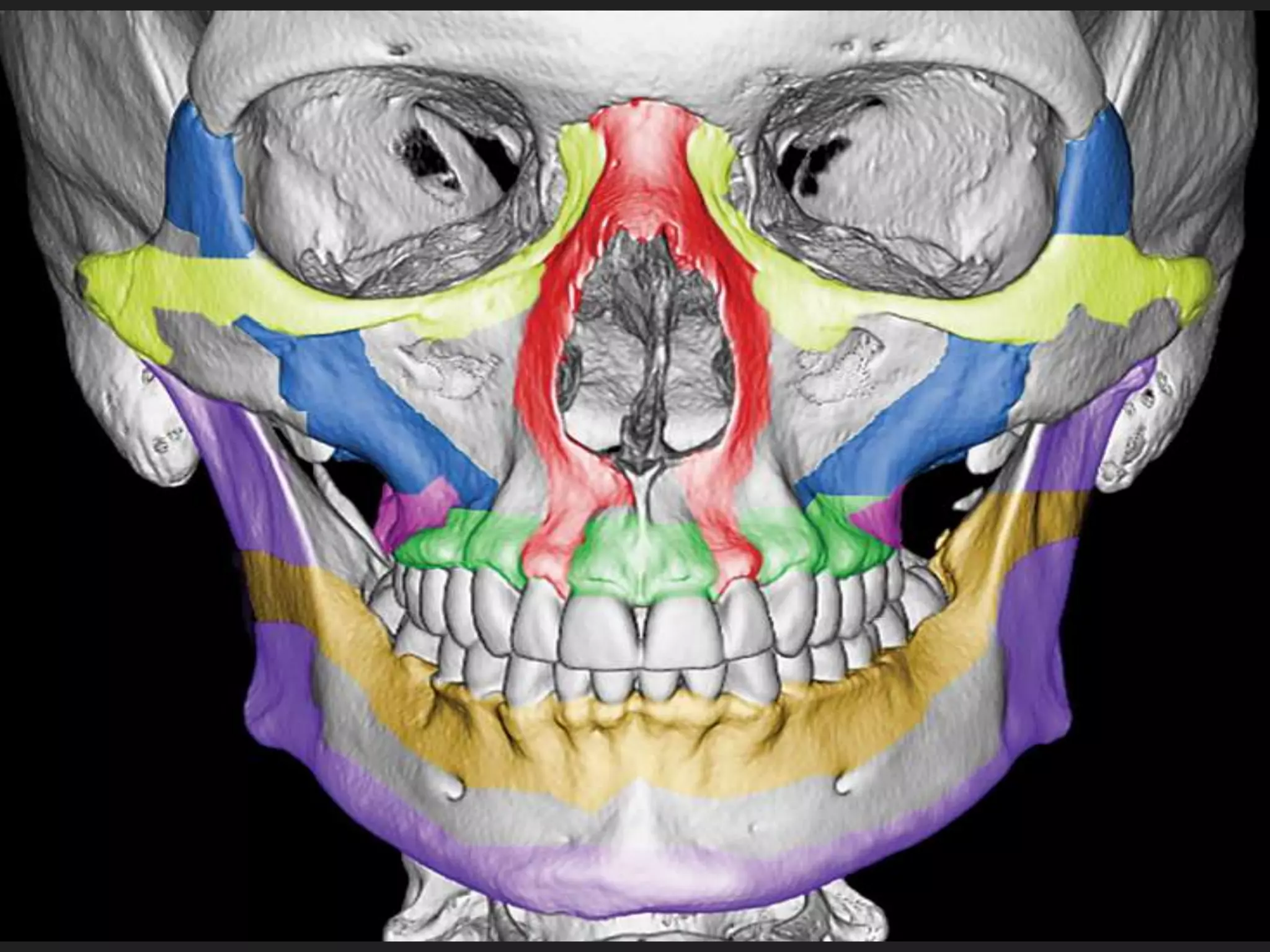 Middle third fractures | PPSX