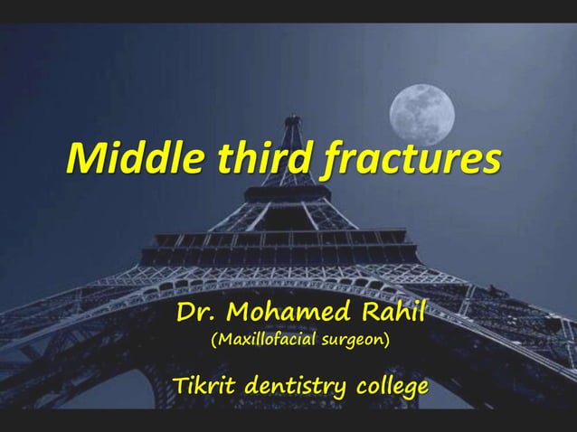 Middle third fractures | PPSX