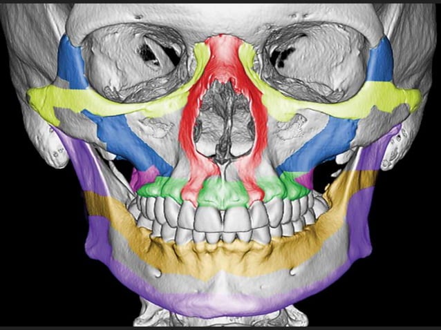 Middle third fractures | PPSX