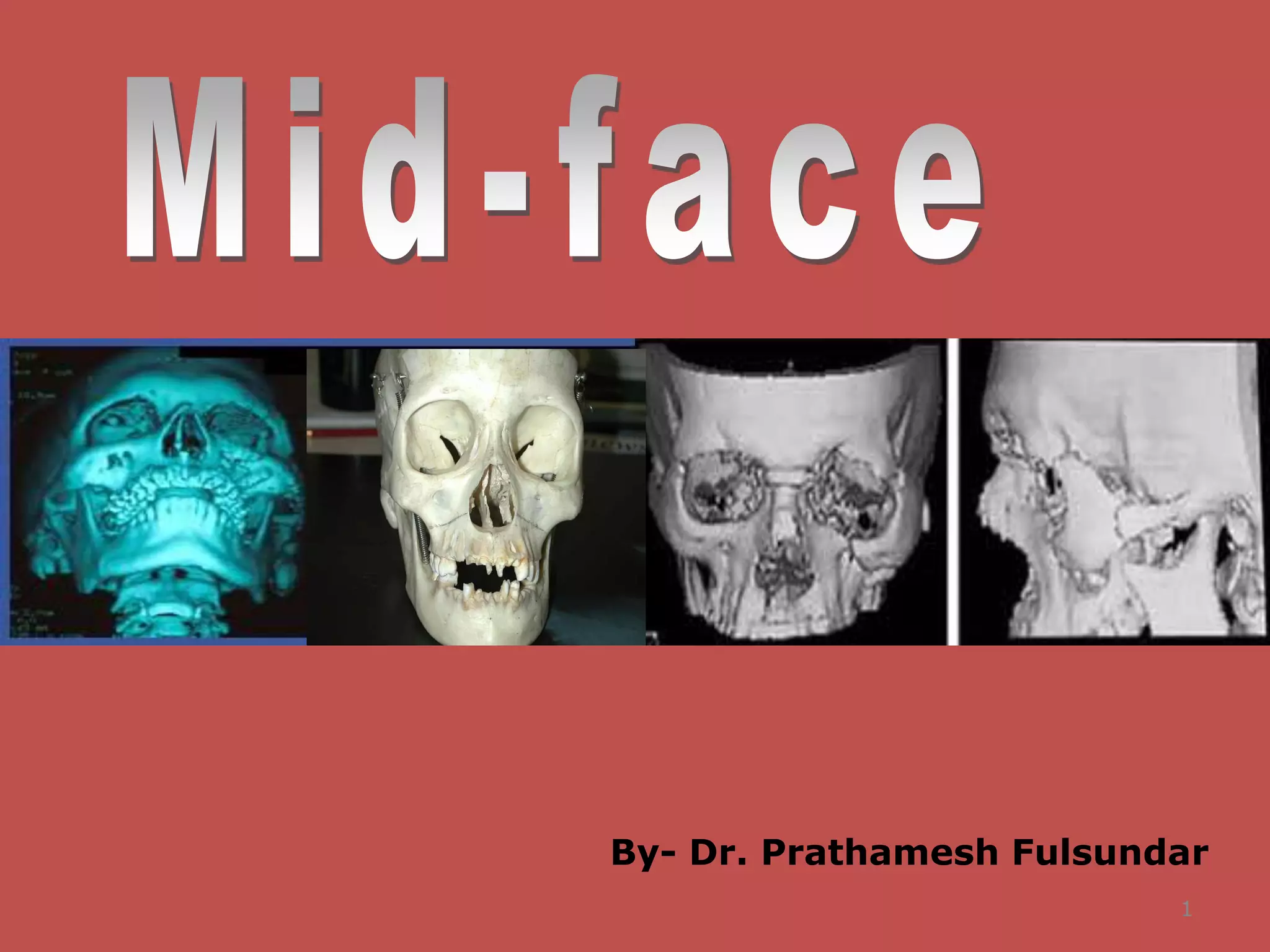 Mid face trauma | PPTX