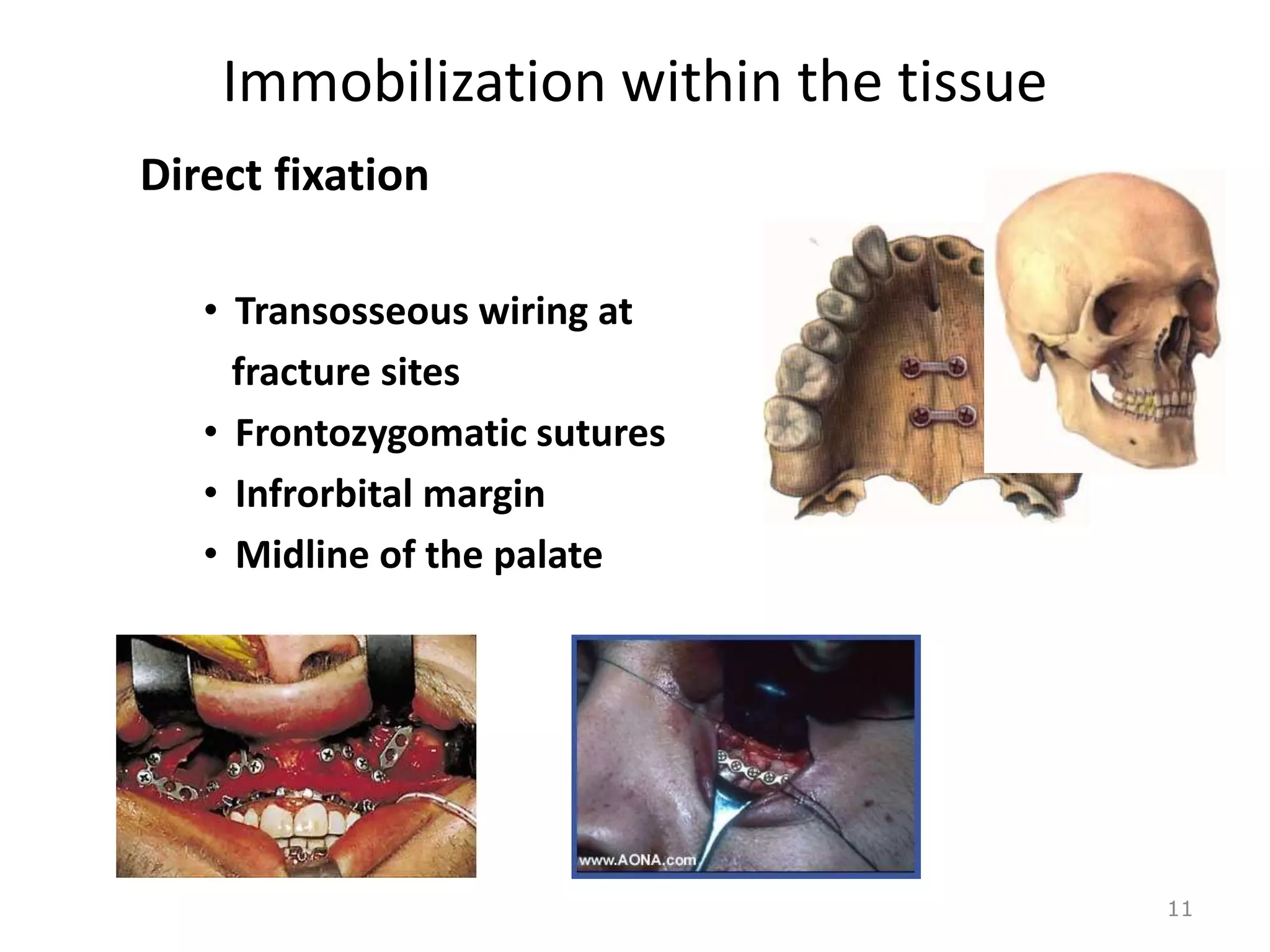Mid face trauma | PPTX