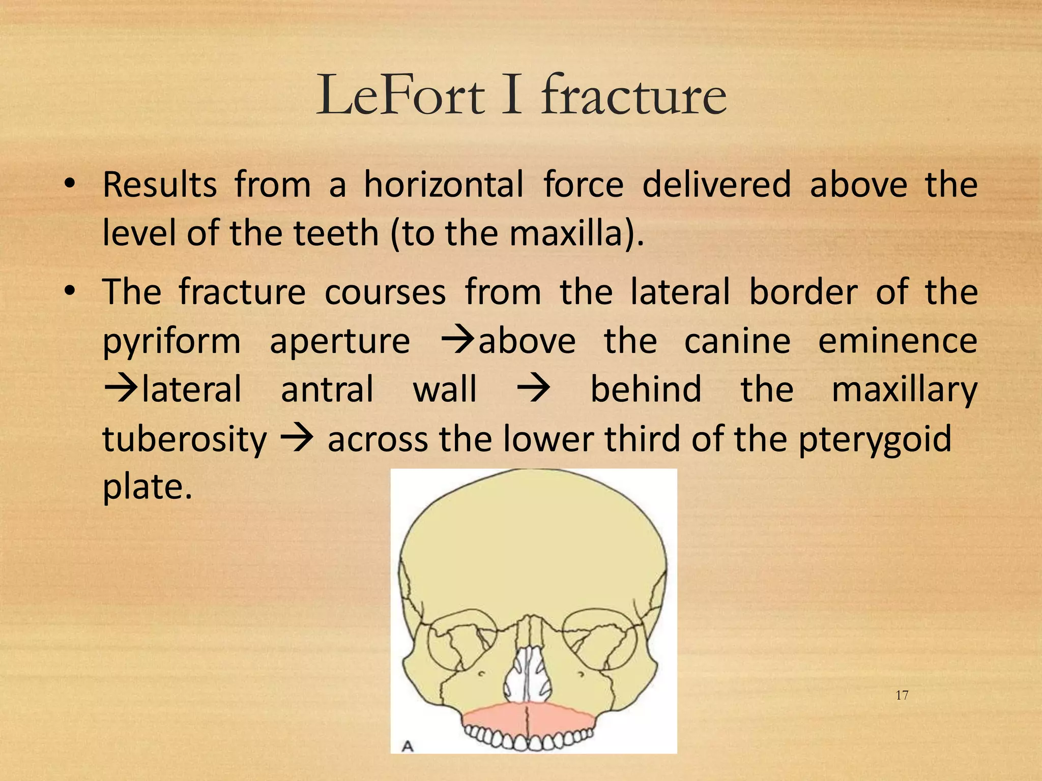 Le Fort Fractures | PDF