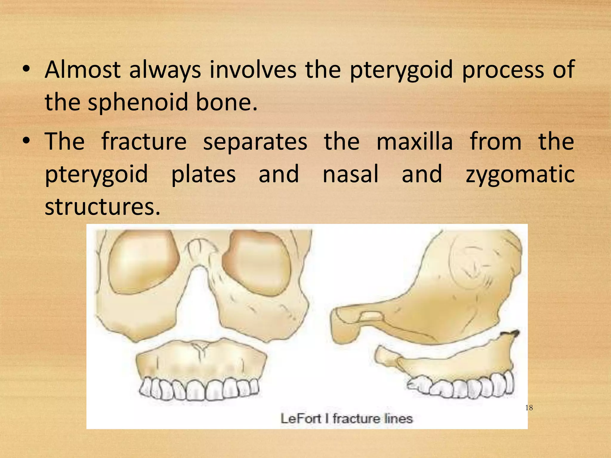 Le Fort Fractures | PDF