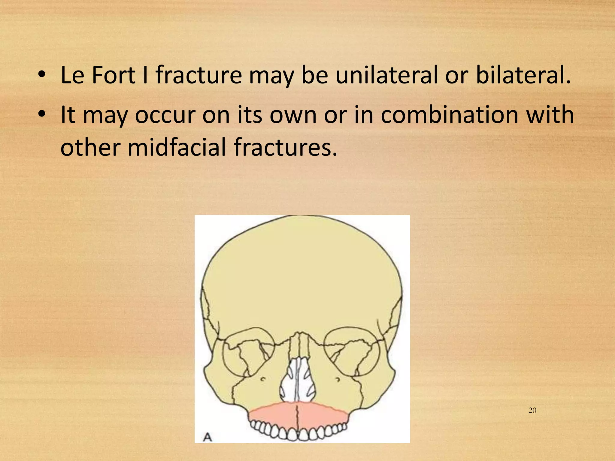 Le Fort Fractures | PDF