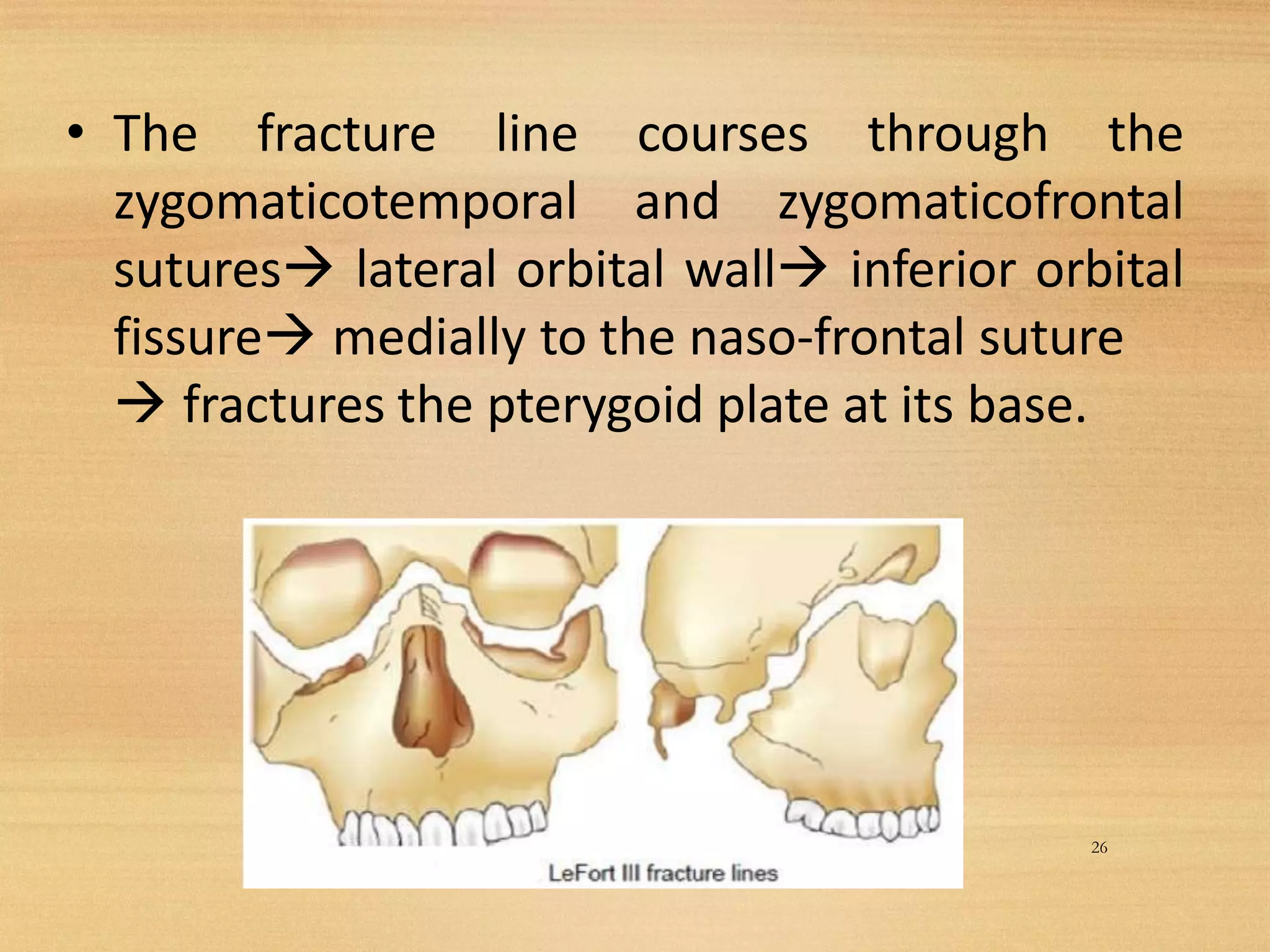 Le Fort Fractures | PDF