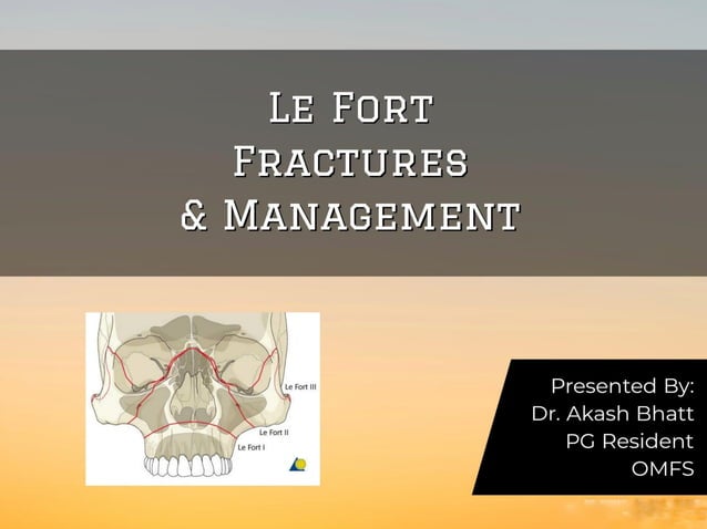 Le Fort Fractures | PDF
