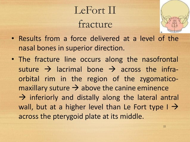 Le Fort Fractures | PDF