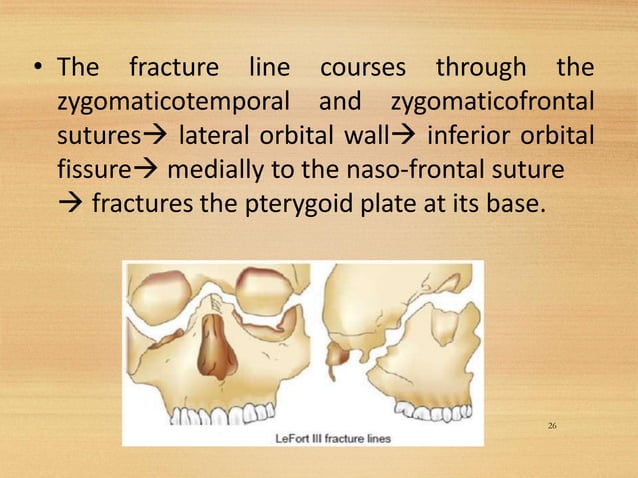 Le Fort Fractures | PDF