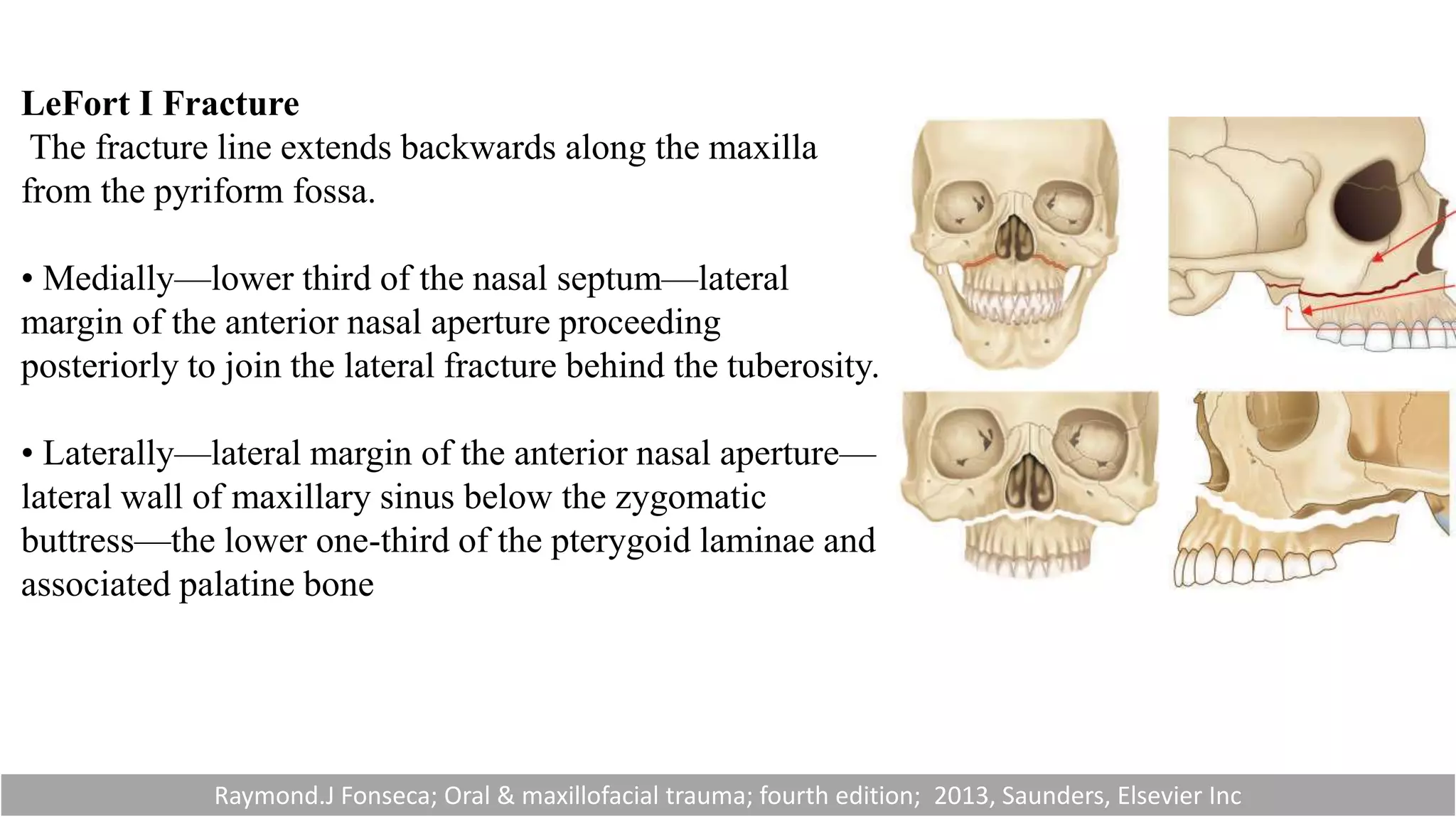 Midface fracture.pptx | Death, Injury, or Military Conflict | Sensitive ...