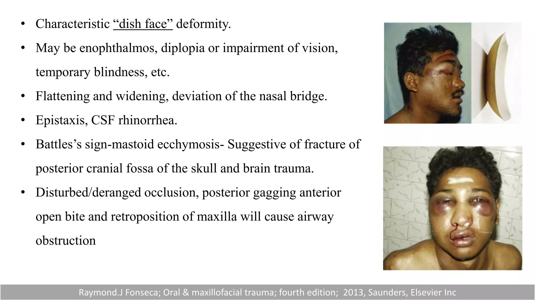 Midface fracture.pptx