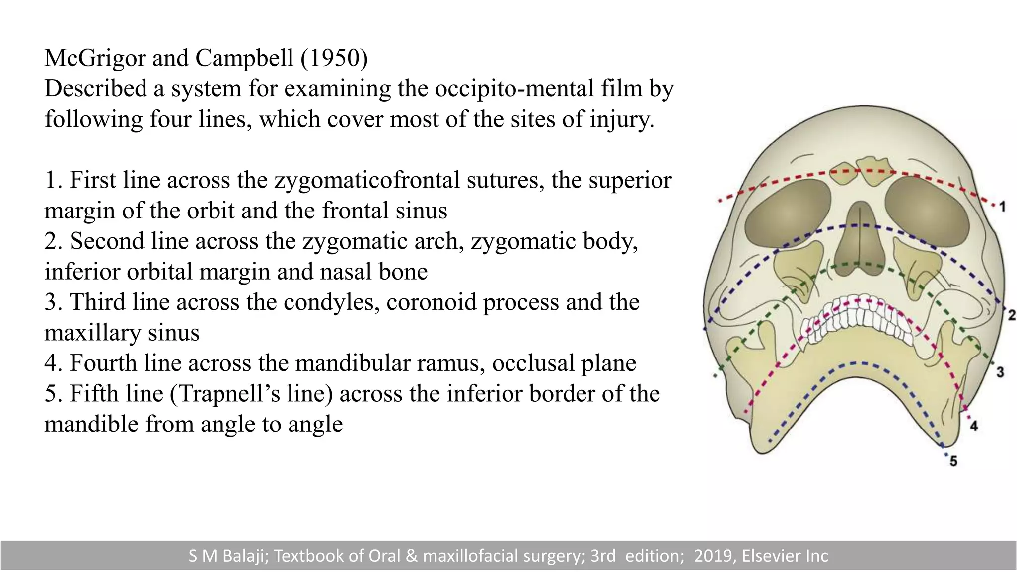 Midface fracture.pptx