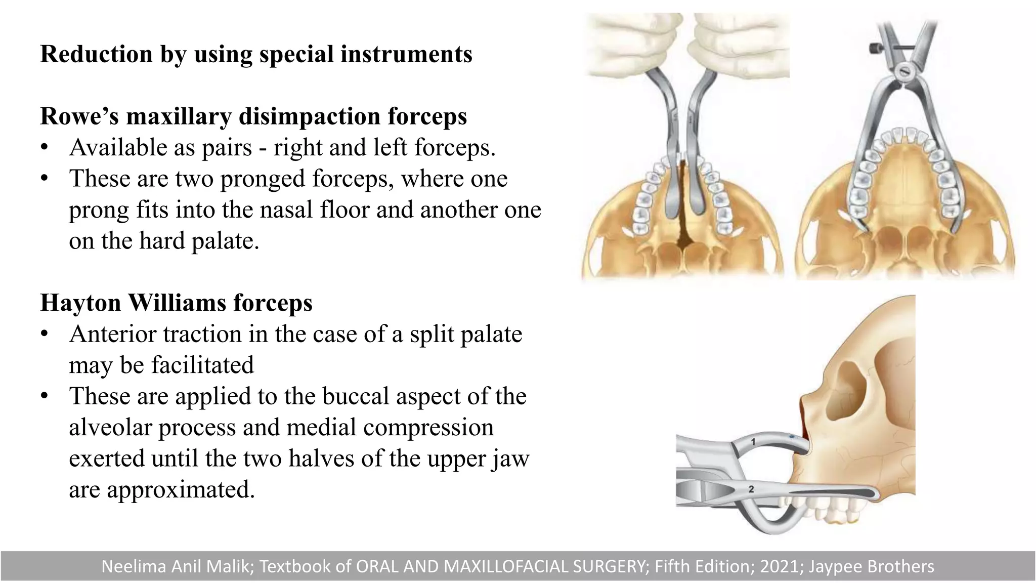 Midface fracture.pptx