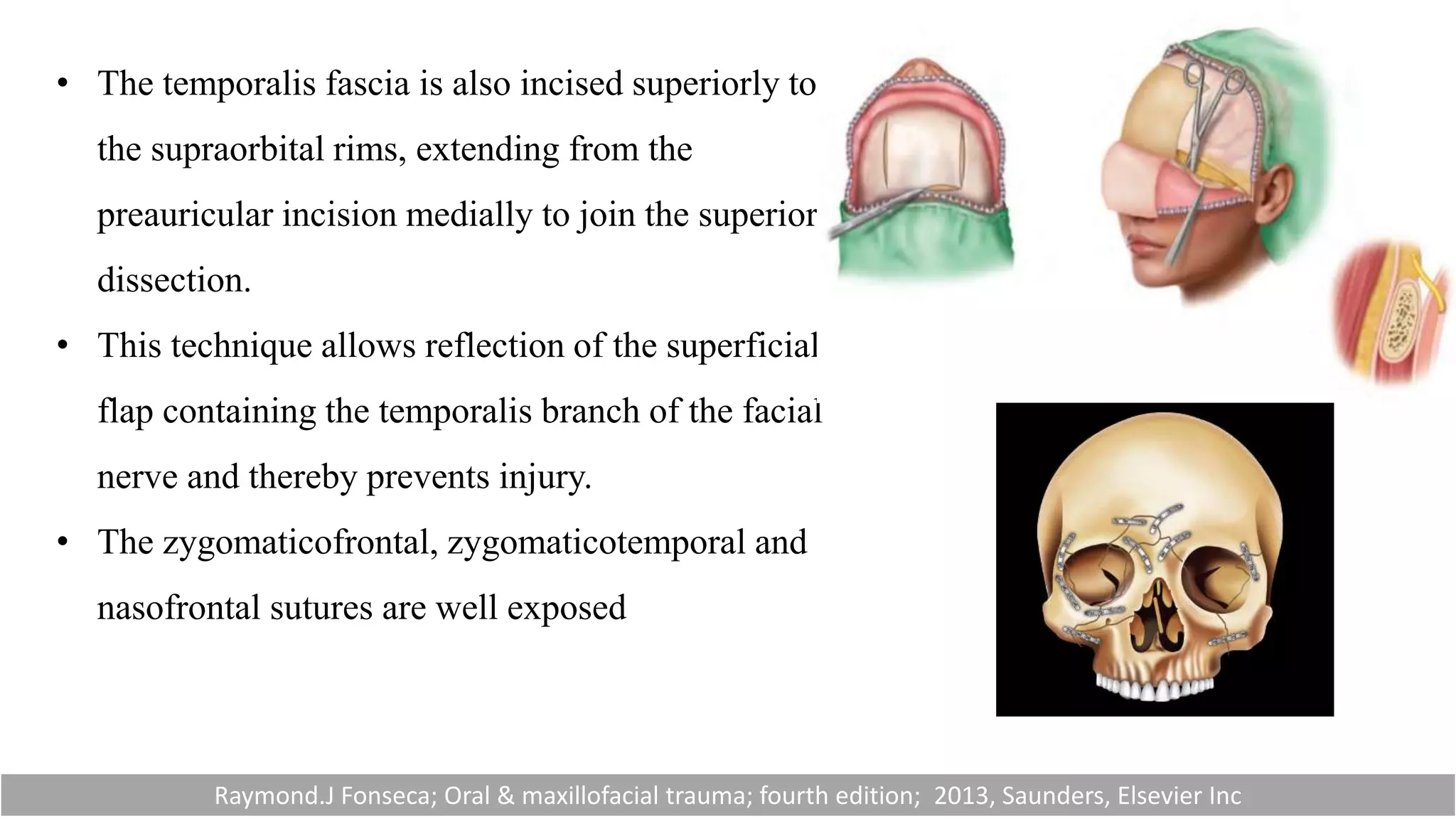 Midface fracture.pptx