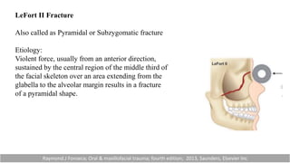 Midface fracture.pptx