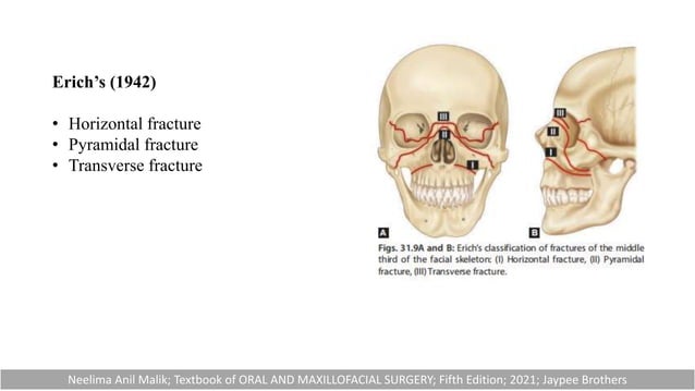 Midface fracture.pptx | Death, Injury, or Military Conflict | Sensitive ...