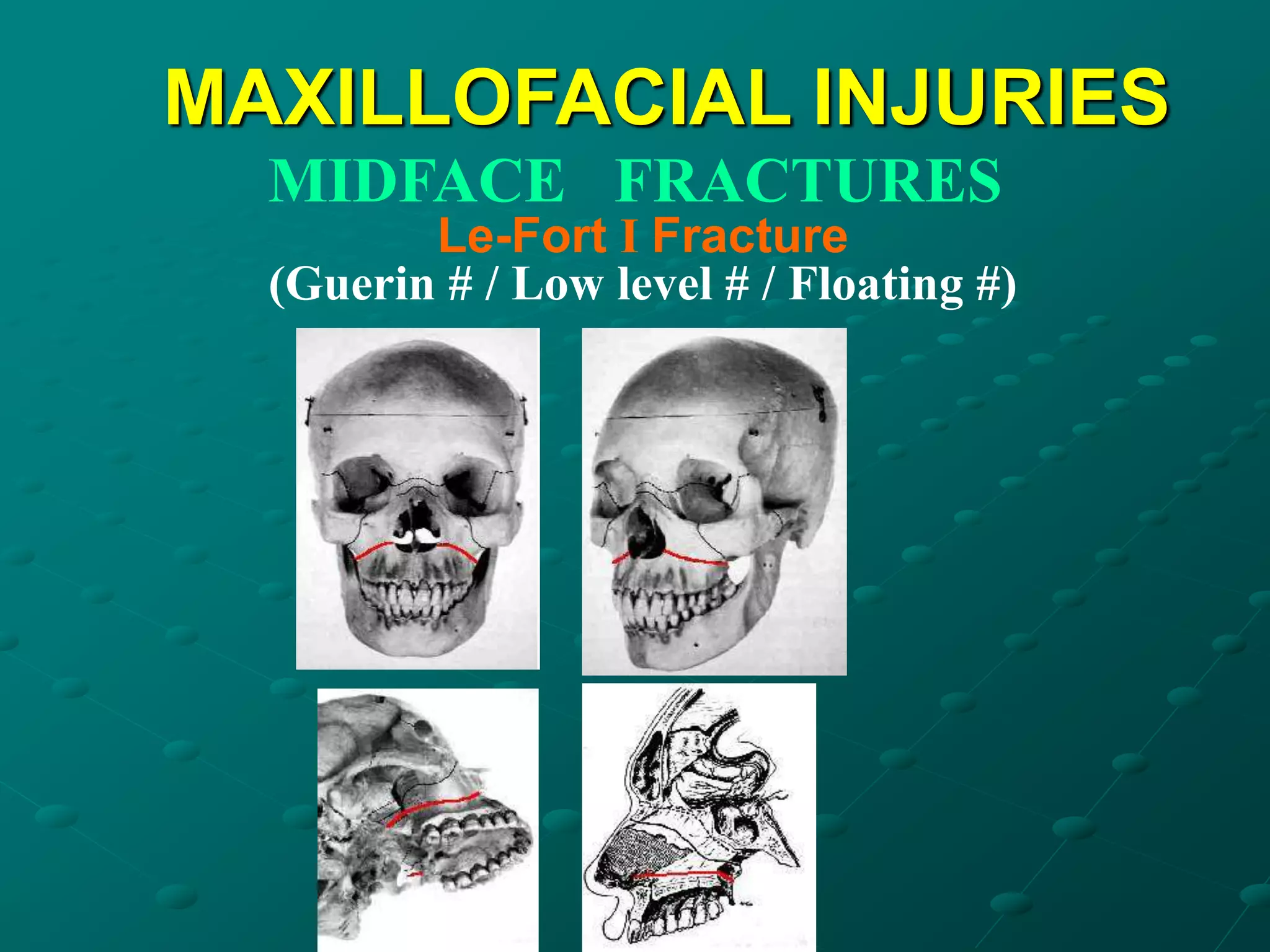 Midface Fracture Part-1.ppt