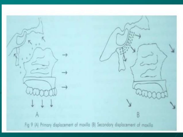 Midface Fracture Part-1.ppt