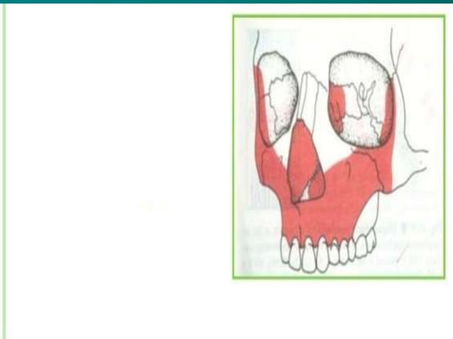 Midface Fracture Part-1.ppt