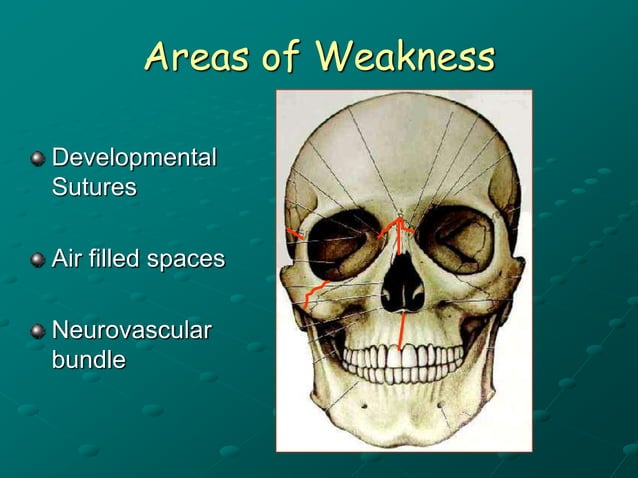 Midface Fracture Part-1.ppt