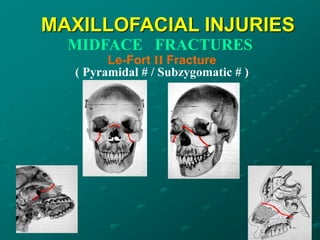 Midface Fracture Part-1.ppt