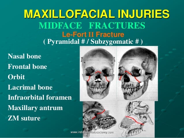 Mid face fractures /certified fixed orthodontic courses by Indian den…