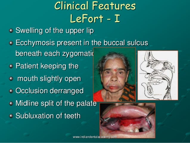 Mid face fractures /certified fixed orthodontic courses by Indian den…