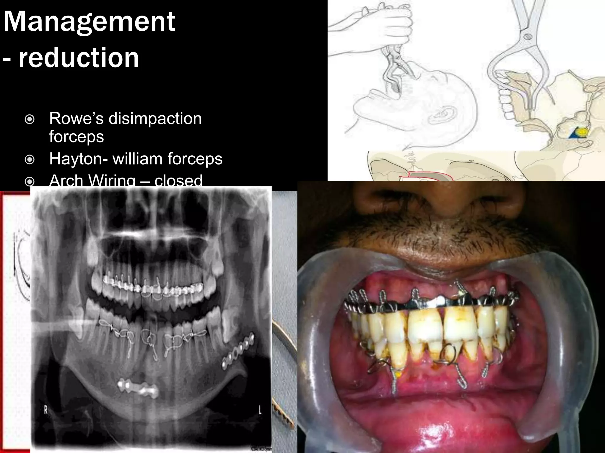 Mid face fractures 1 8 | PPTX