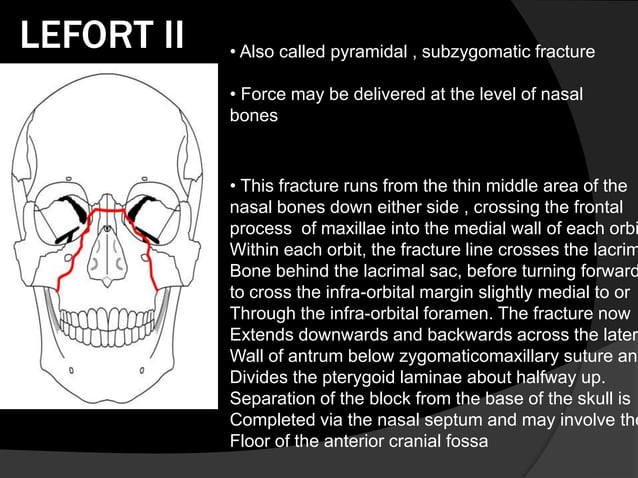 Mid face fractures 1 8 | PPTX | Death, Injury, or Military Conflict ...