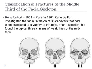 Mid facial fractures | PPTX