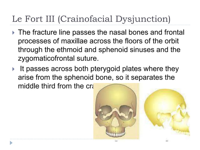 Mid facial fractures | PPTX