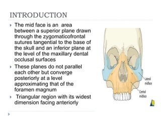 Mid facial fractures | PPTX