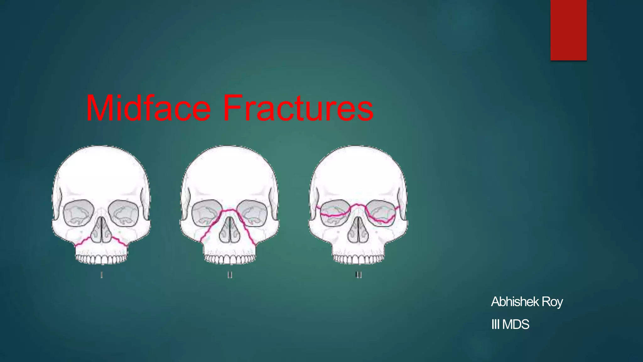 Midface fractures | PPTX