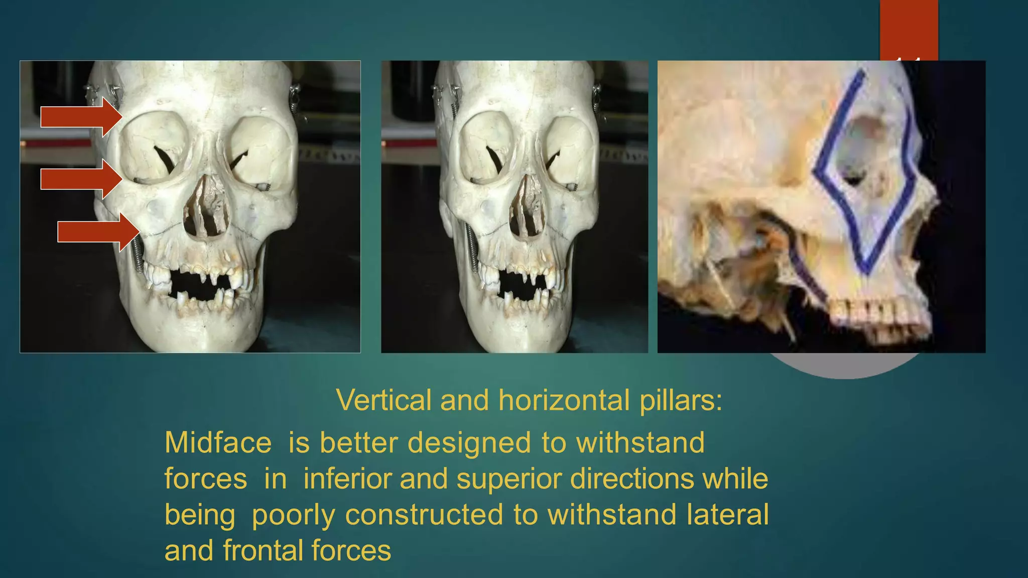 Midface fractures | PPTX